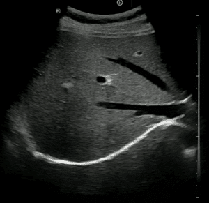 Ecogenicidad: definición, guía y prácticas | Sonoscanner