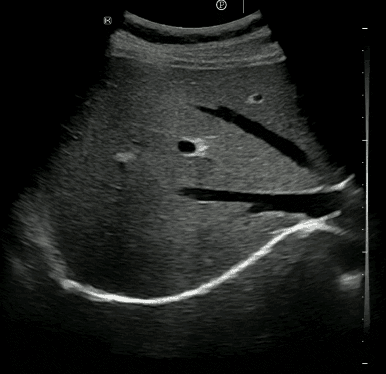 Ecogenicidad: definición, guía y prácticas | Sonoscanner