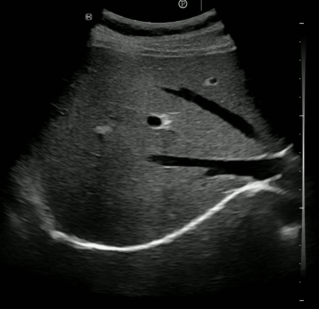 Ecogenicidad: definición, guía y prácticas | Sonoscanner